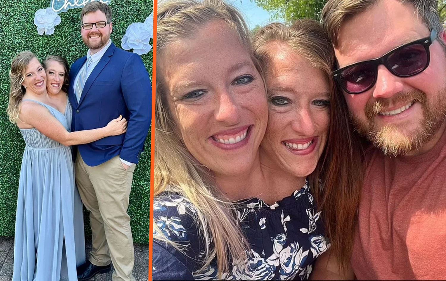 Bel Altındaki Organları Ortak Olan Yapışık Ikizler Evlendi • Batman Burada